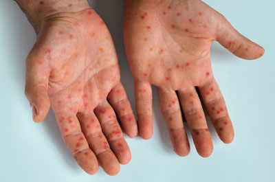 Saint Lucia News - Health Ministry Enhances Mpox Precautionary Measures ...